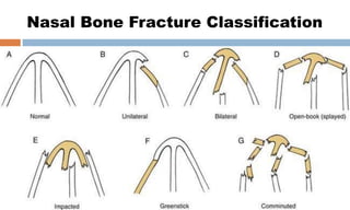 Cranial and facial fractures | PPTX