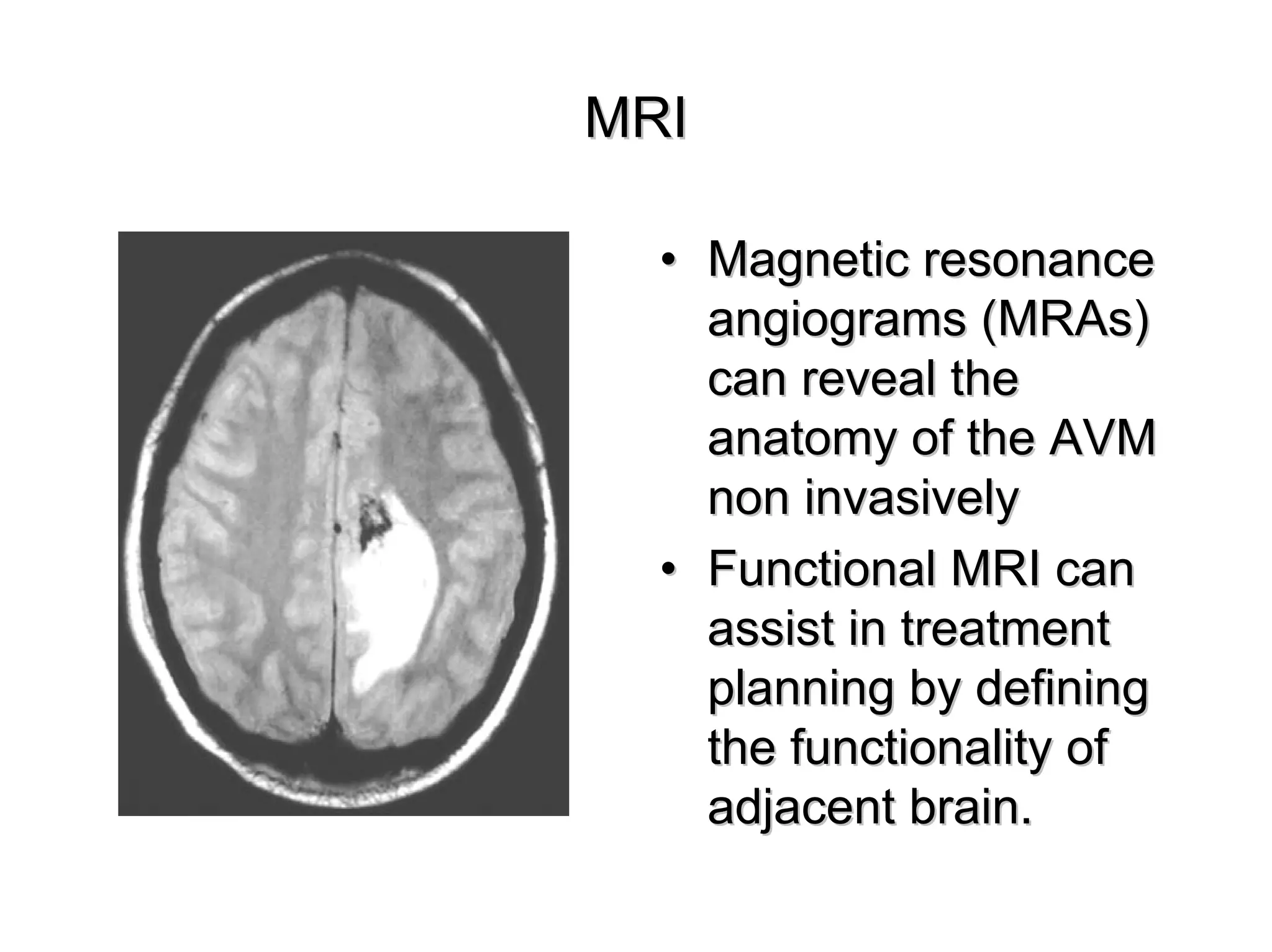 Cerebral AVM | PDF