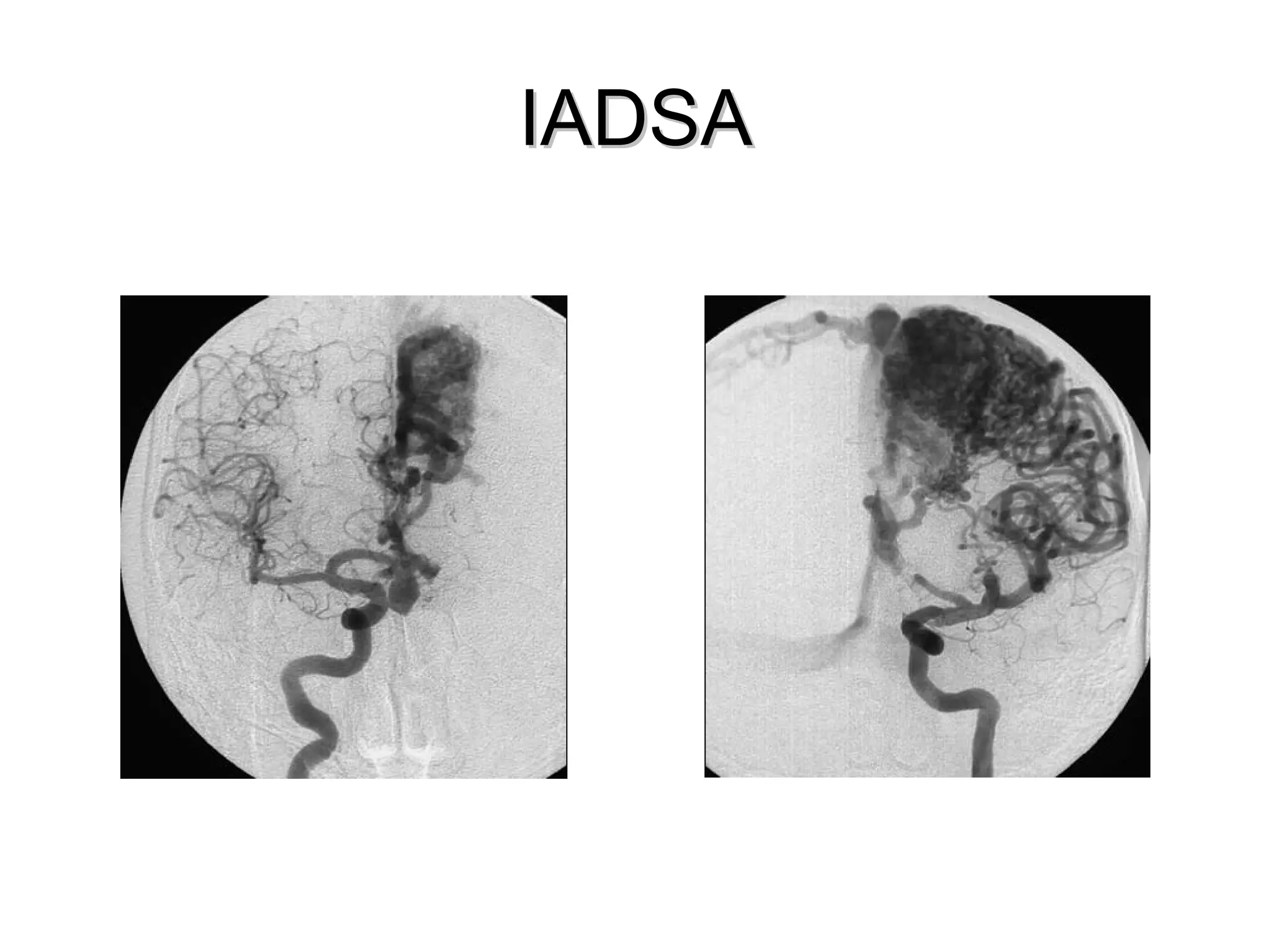 Cerebral AVM | PDF | Blood Disorders | Diseases and Conditions