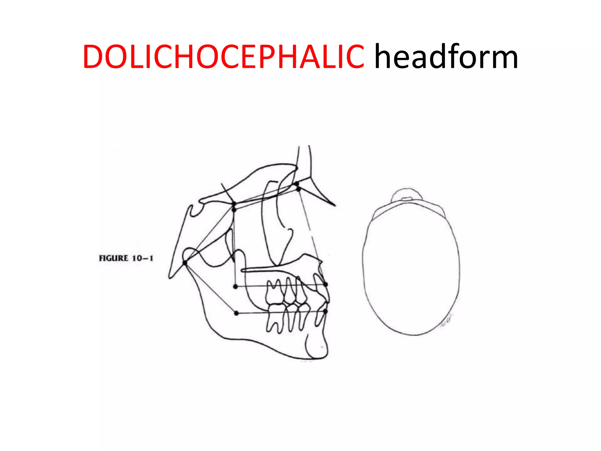 Cranial base angle in relation to malocclusion | PPTX