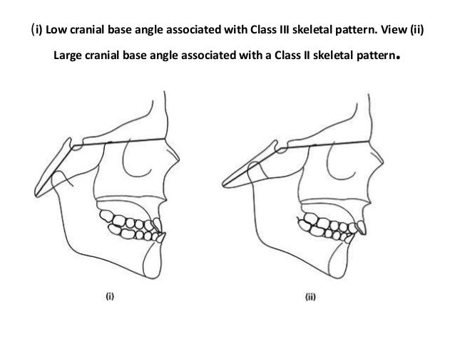 Cranial base angle in relation to malocclusion