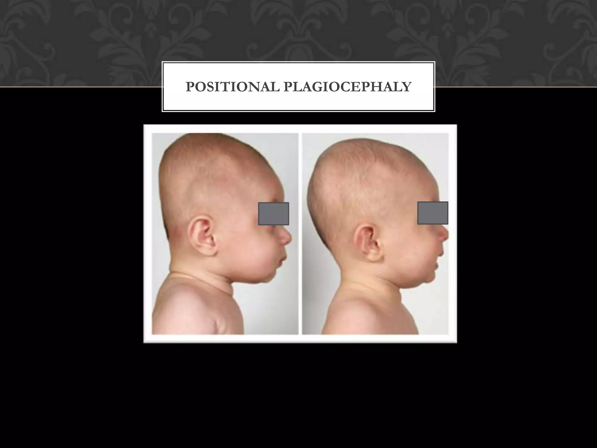 Cranial Deformitas | PPTX