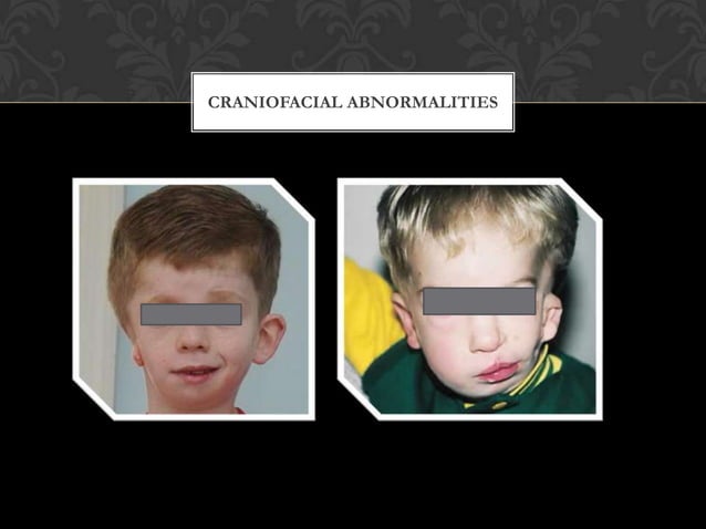 Cranial Deformitas | PPT