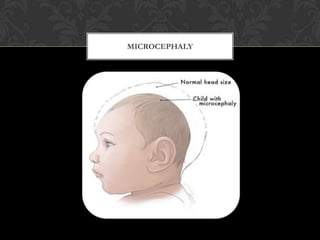 Cranial Deformitas | PPT