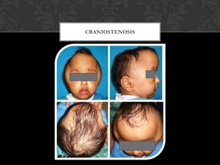 Cranial Deformitas | PPTX