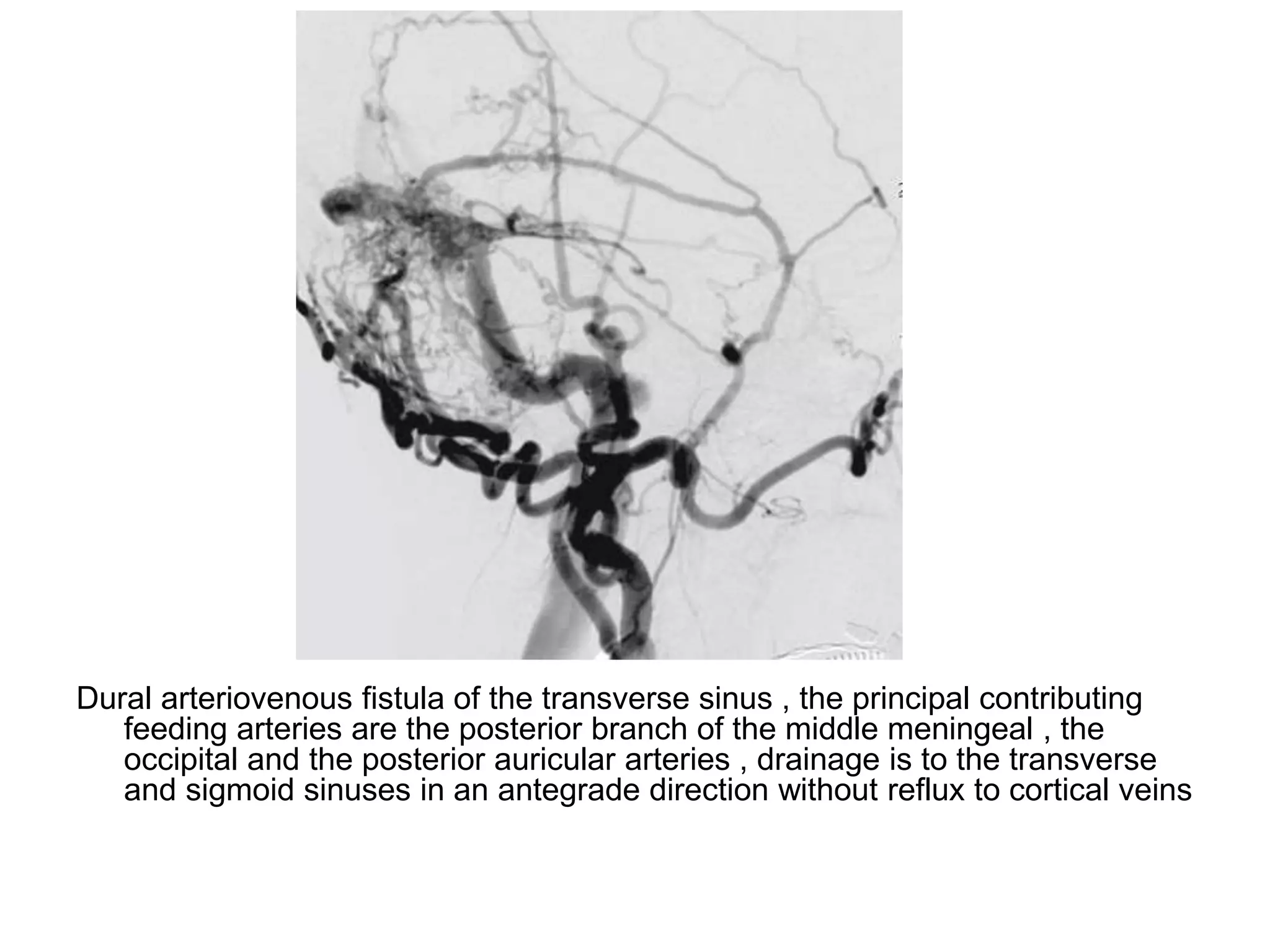 Cranial dural arteriovenous fistulas | PPT