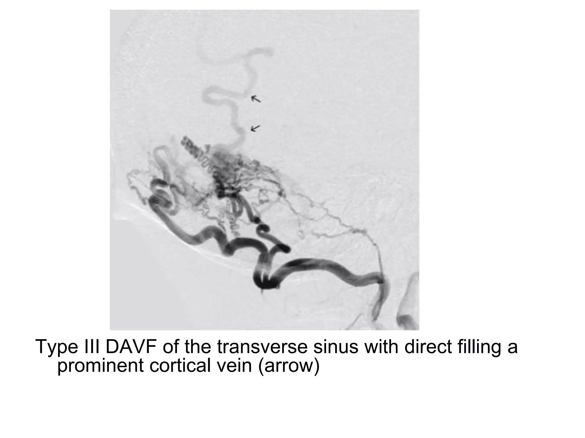 Cranial dural arteriovenous fistulas | PPT