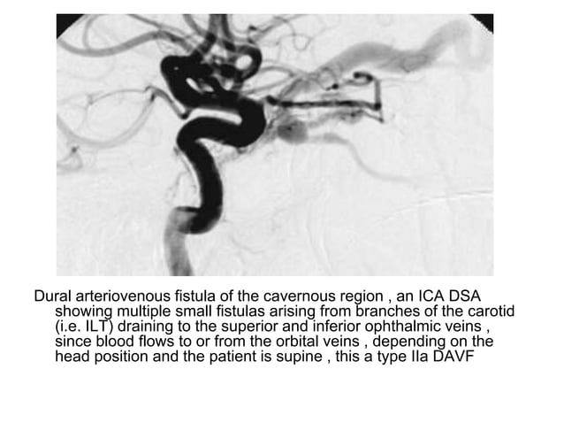 Cranial dural arteriovenous fistulas | PPT