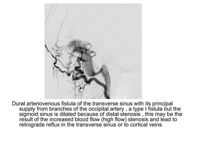 Cranial dural arteriovenous fistulas | PPT