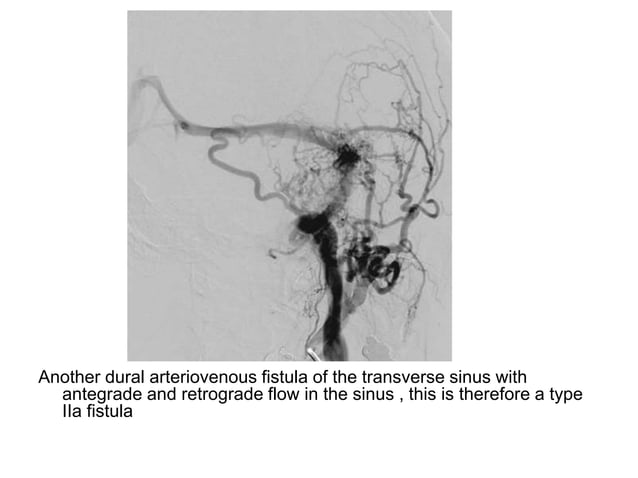 Cranial dural arteriovenous fistulas | PPT