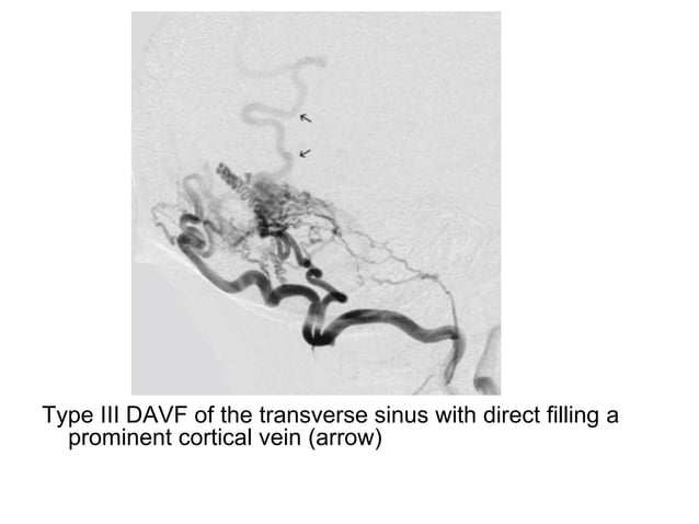 Cranial dural arteriovenous fistulas | PPT