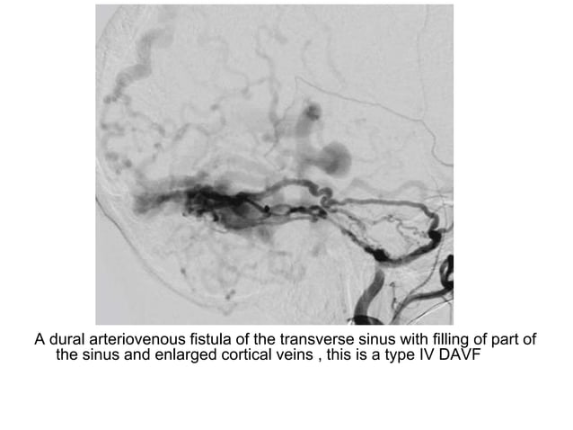 Cranial dural arteriovenous fistulas | PPT
