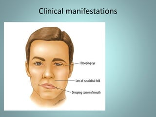 Cranial nerve disorders Bell’s palsy (facial paralysis) ,Trigeminal ...