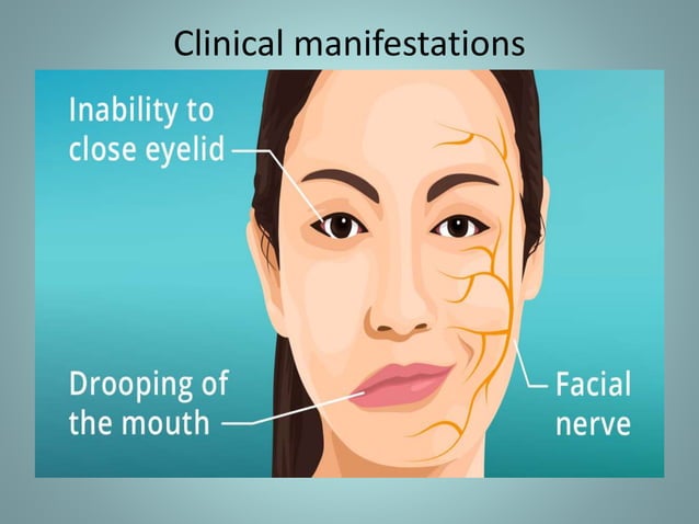 Cranial nerve disorders Bell’s palsy (facial paralysis) ,Trigeminal ...