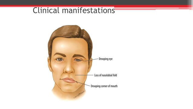 Cranial nerve disorders | PPTX | Brain and Nervous System Disorders ...