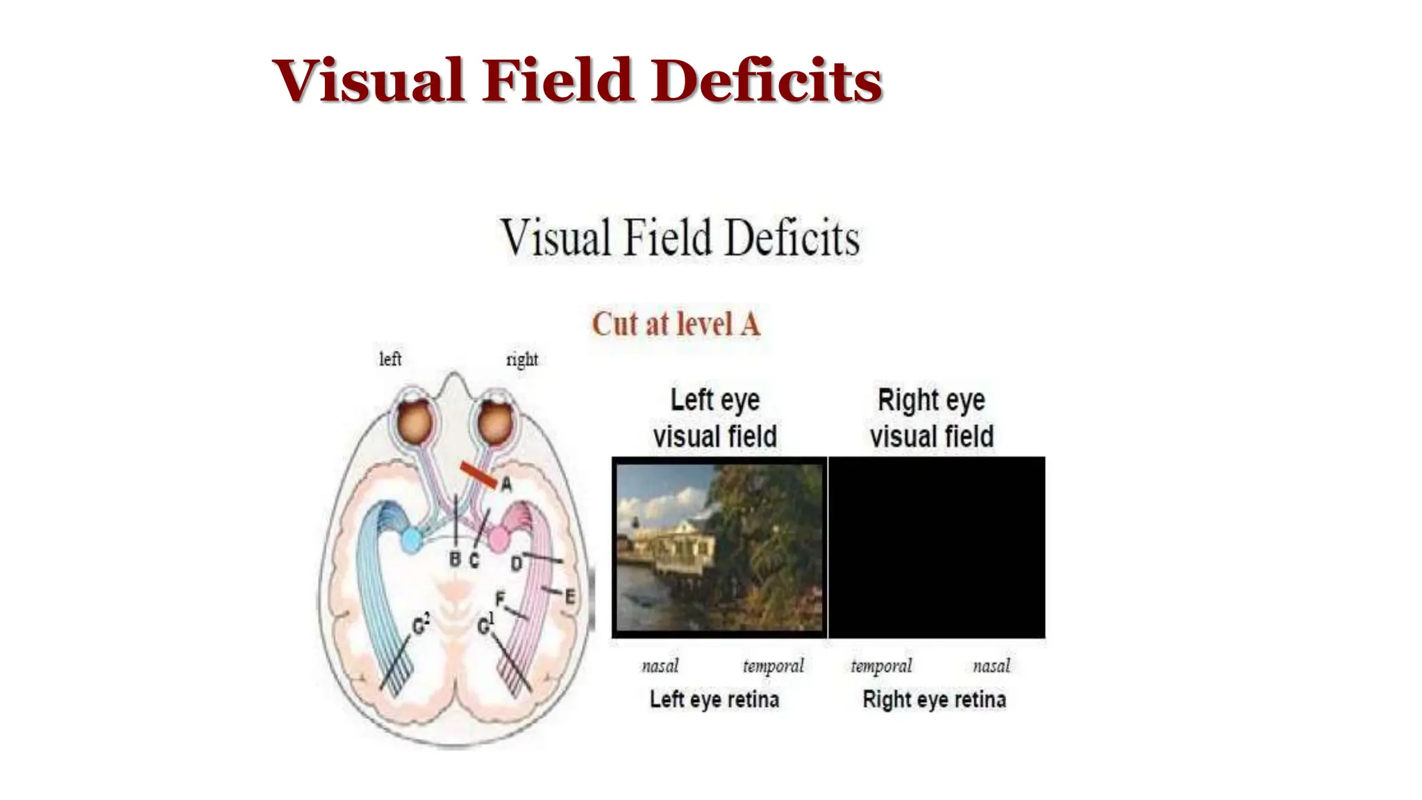 Cranial Nerve II and Visual Pathways.pptx