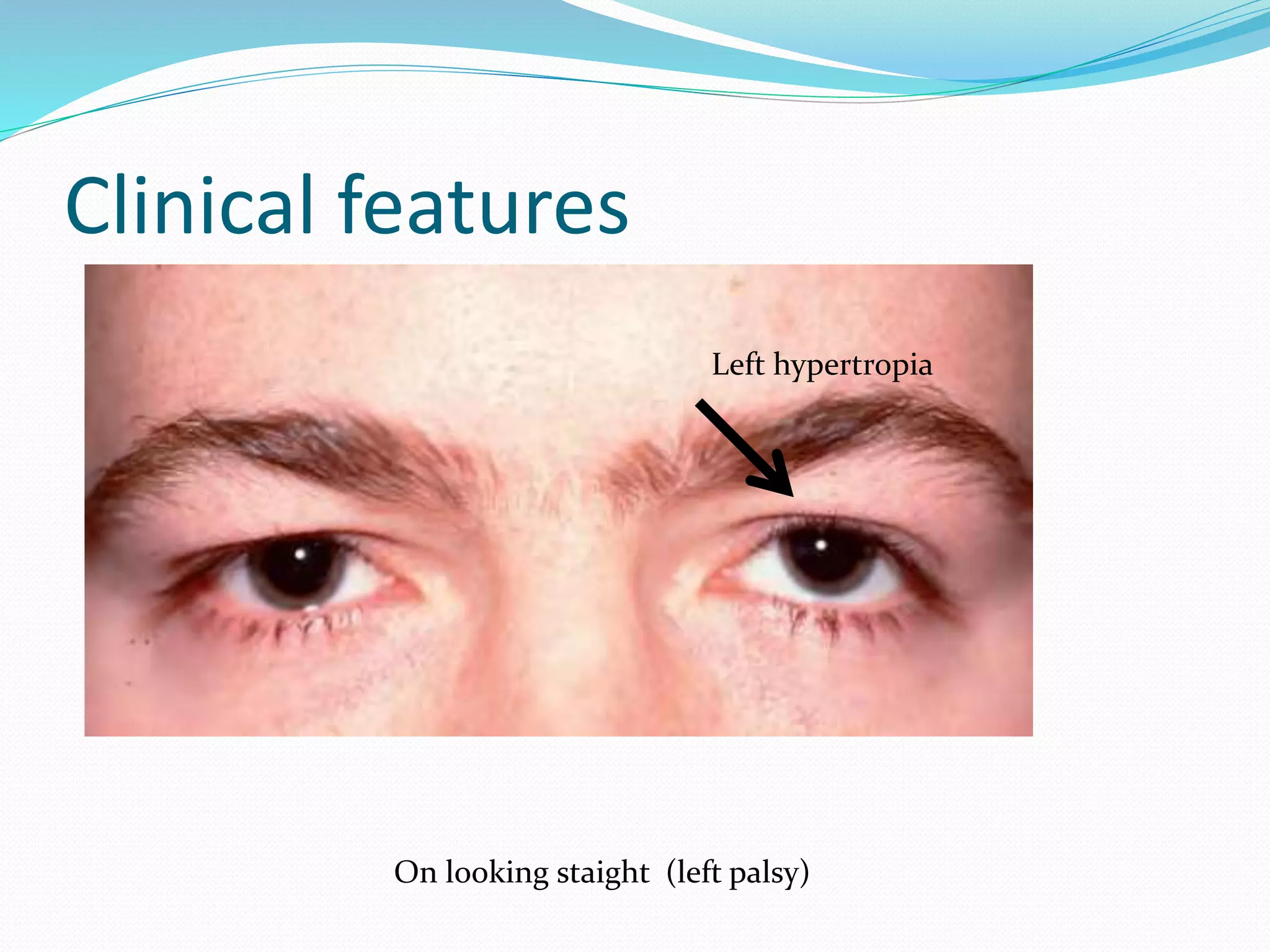 Cranial nerve iv and vi | PPTX
