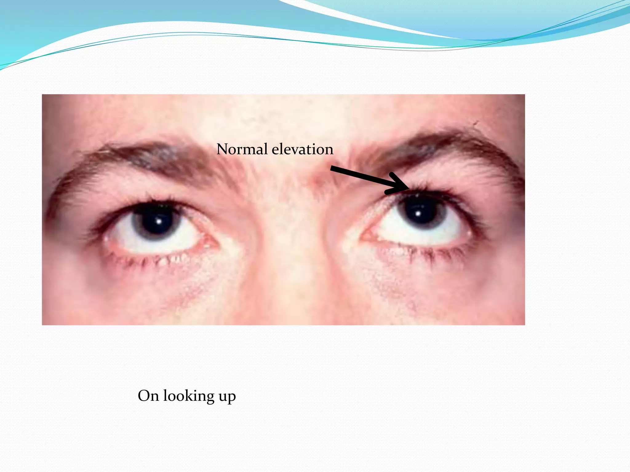 Cranial nerve iv and vi | PPTX