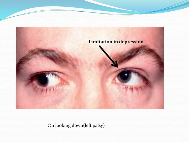 Cranial nerve iv and vi | PPT