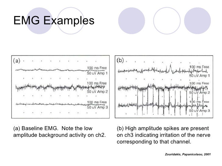 Cranial Nerve Monitoring