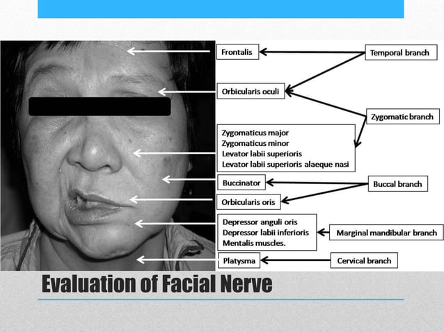 Diseases of Cranial nerves 5th, 7th and 8th | PPT