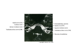 Cranial nerves part ii | PPT