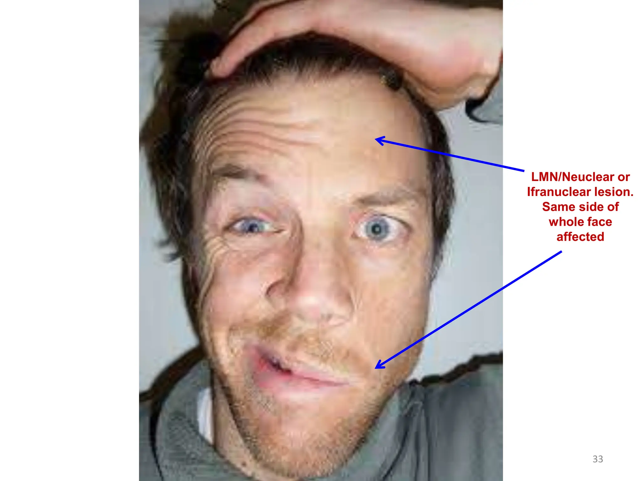 Cranial Nerves Vii And Viii Applied And Anatomypptx