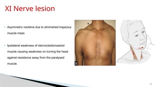 Examination of lower cranial nervesCRANIAL NERVES (XI,XII) | PPTX