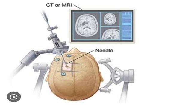 Cranial surgery.It's techniques intervention pptx | PPTX