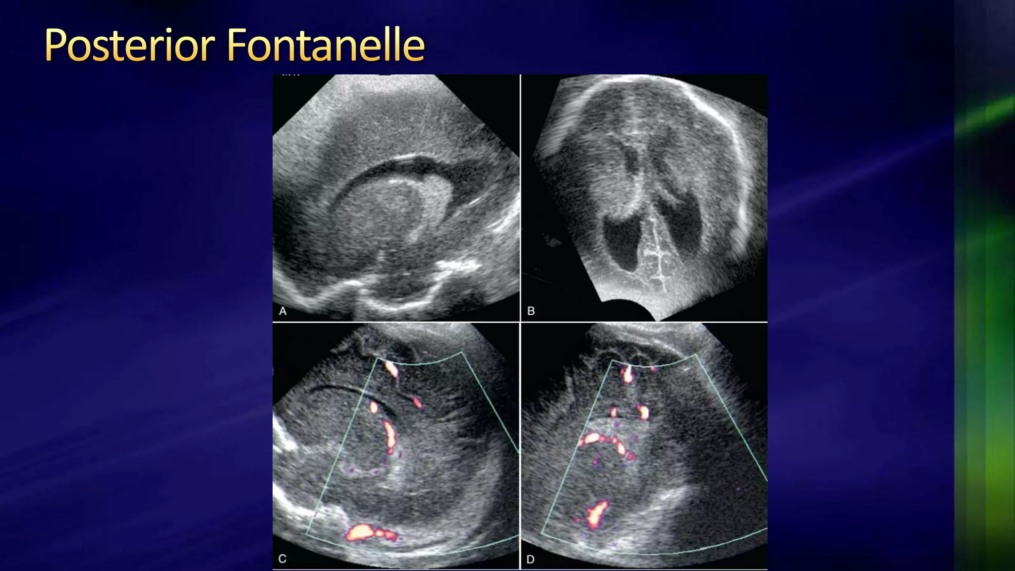 TRANSCRANIAL ULTRASOUND | PPTX