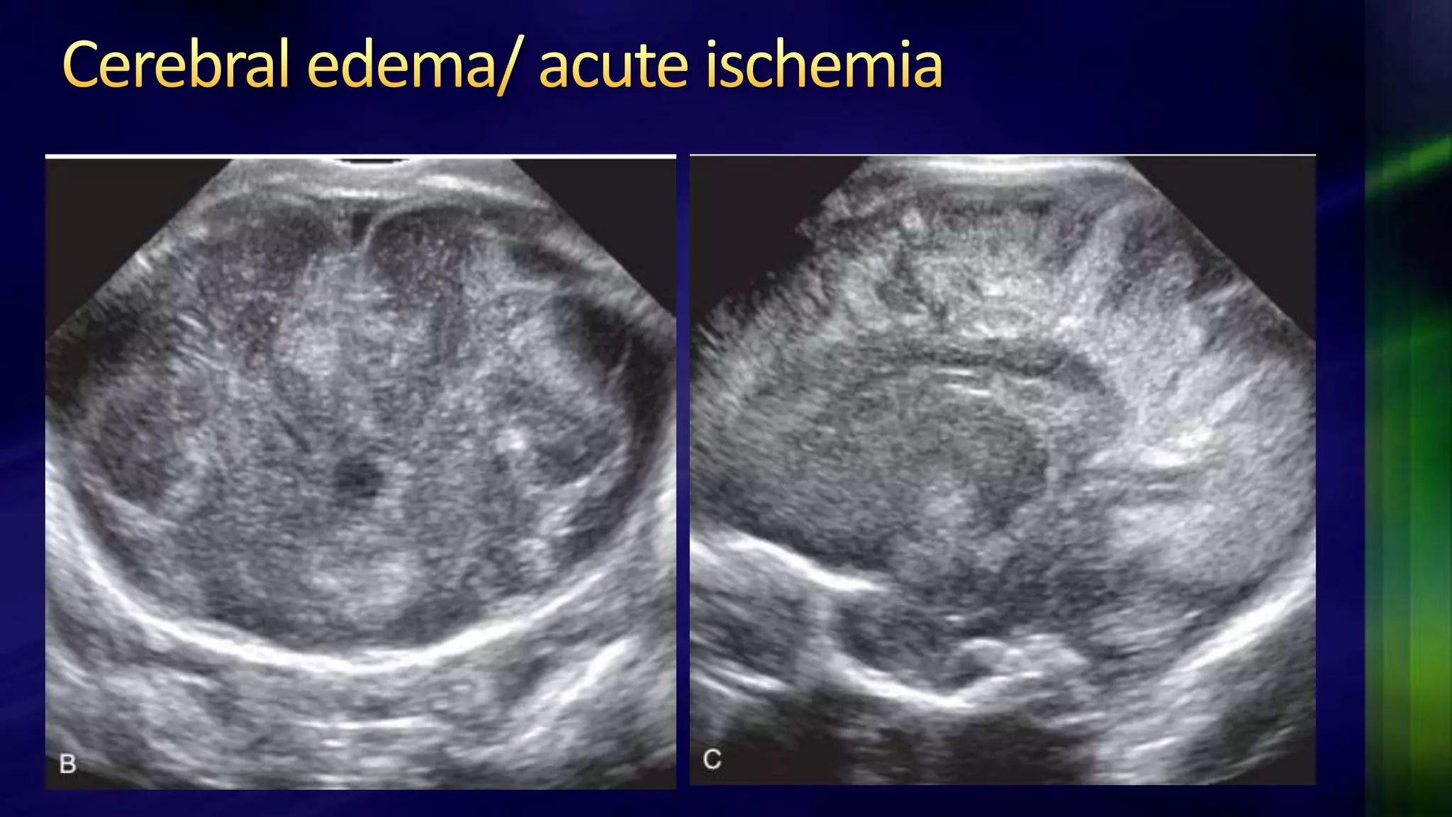 TRANSCRANIAL ULTRASOUND | PPTX