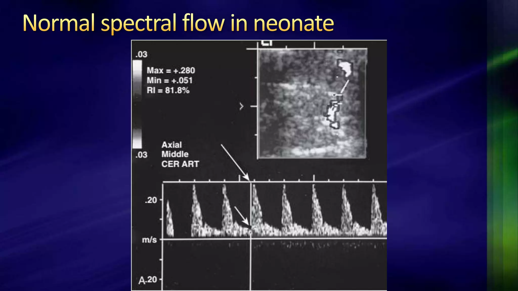 TRANSCRANIAL ULTRASOUND | PPTX