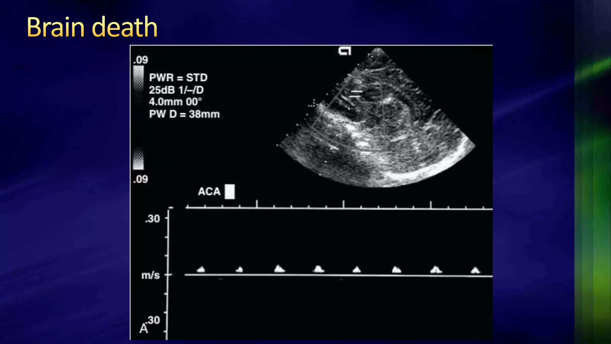 TRANSCRANIAL ULTRASOUND | PPTX