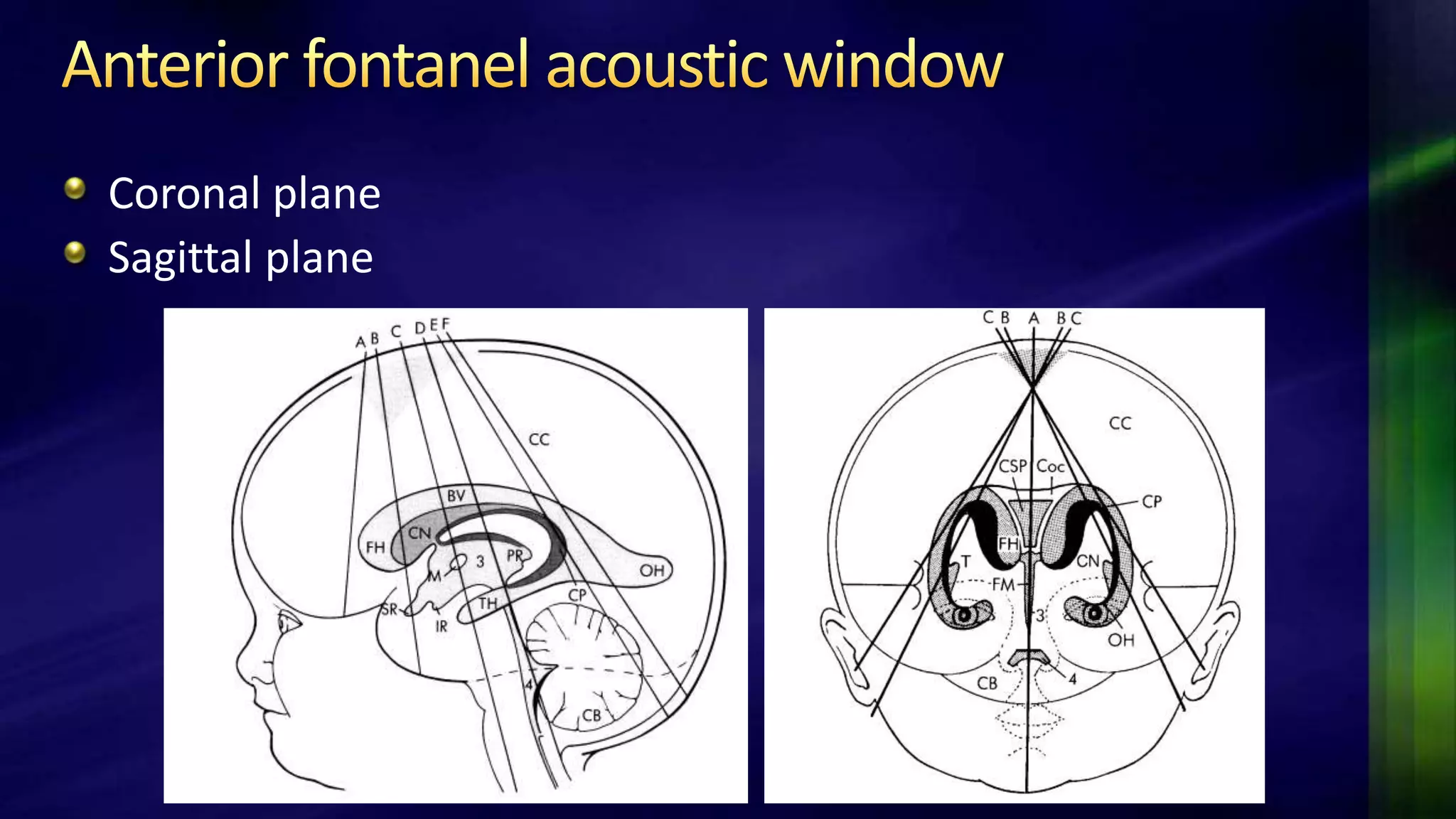 TRANSCRANIAL ULTRASOUND | PPTX