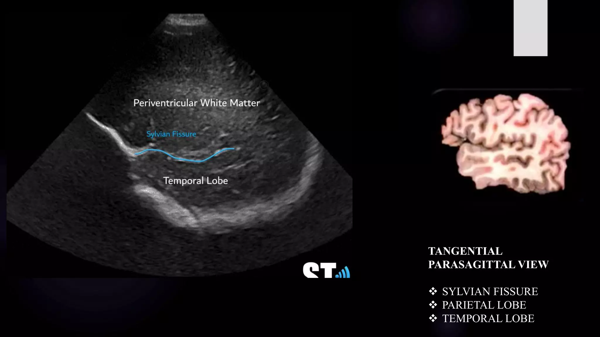 Cranial usg final.pptx
