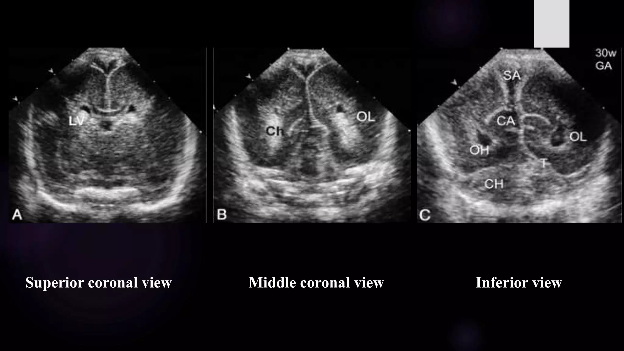 Cranial usg final.pptx
