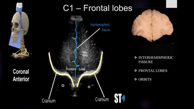 Cranial usg final.pptx | First Aid | Injuries