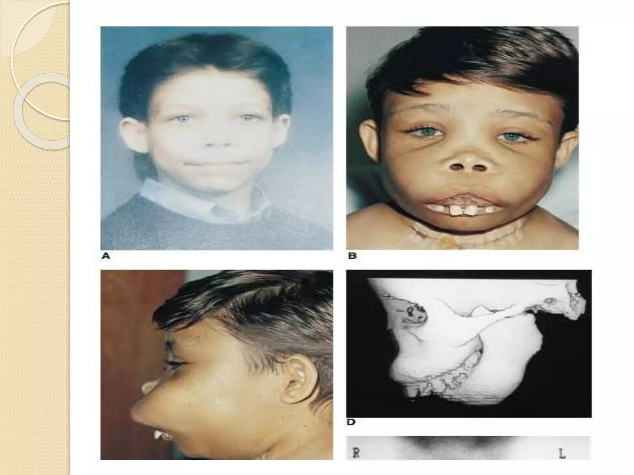 Cranifacial apects of ckd | PPT