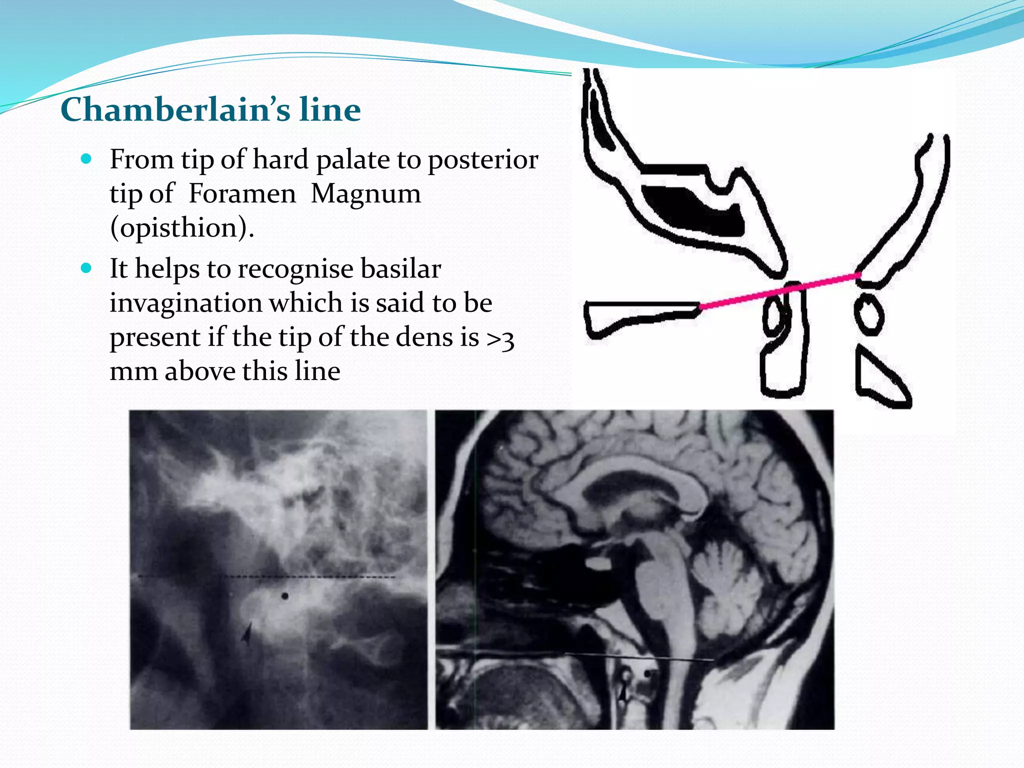 Cranio vertebral anomalies- overview - | PPTX