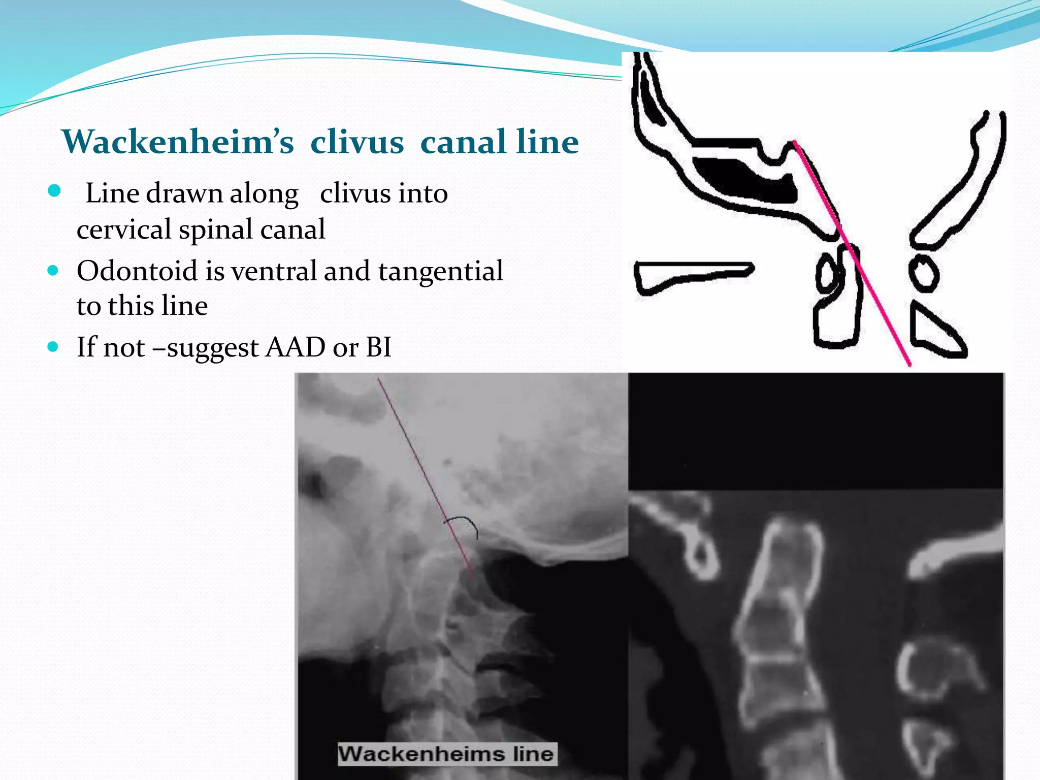Cranio vertebral anomalies- overview - | PPTX