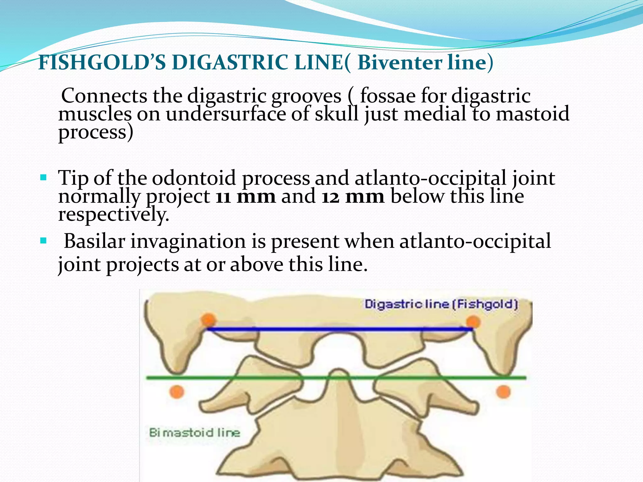 Cranio vertebral anomalies- overview - | PPTX