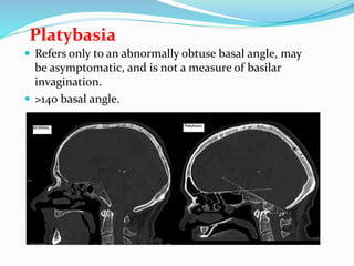 Platybasia