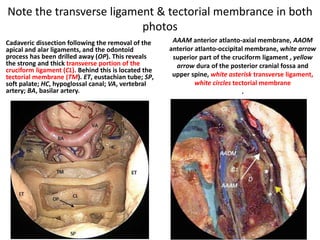 Tectorial Membrane Spine
