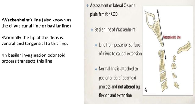 Cranio vertebral junction (CV Junction) - Dr Sameep Koshti (Consultant ...