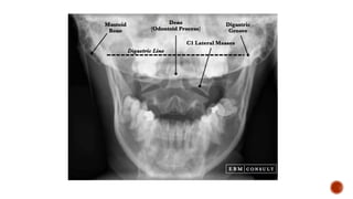 CRANIO-VERTEBRAL JUNCTION (CVJ) LINES-ANGLES | PPTX