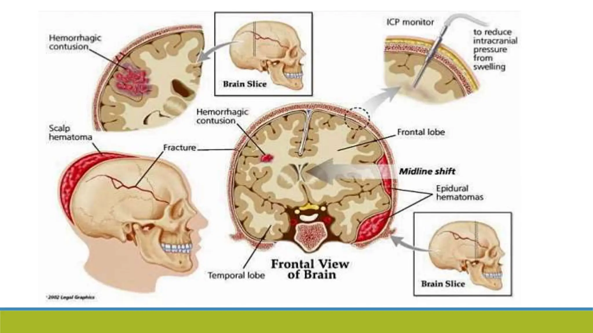 CRANIO – CEREBRAL INJURIES.pptx