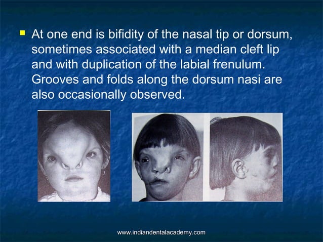 Craniofacial anomalies /certified fixed orthodontic courses by Indian ...