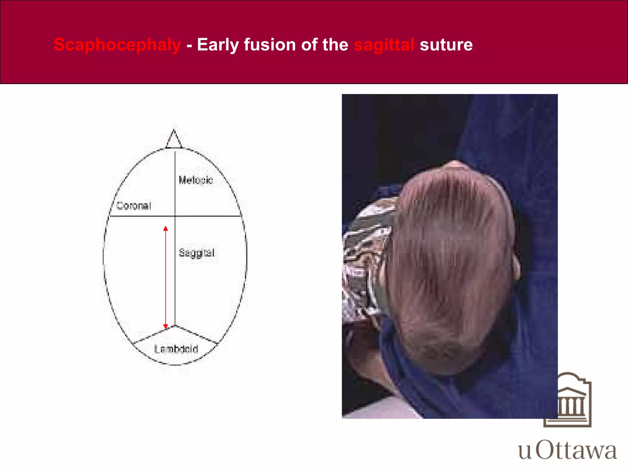 Craniofacial anomalies | PPT