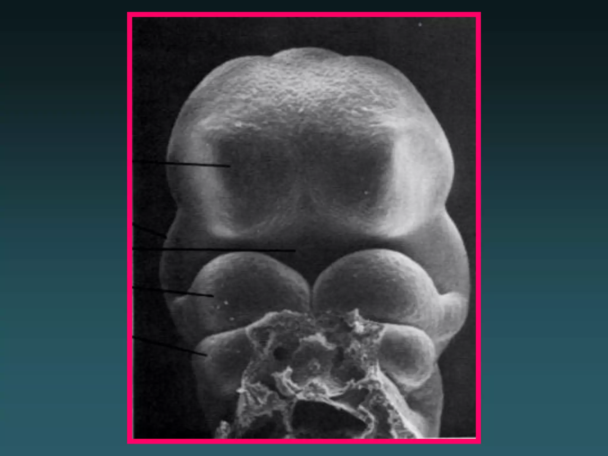 Craniofacial embryology Implications for craniofacial syndromes - July ...