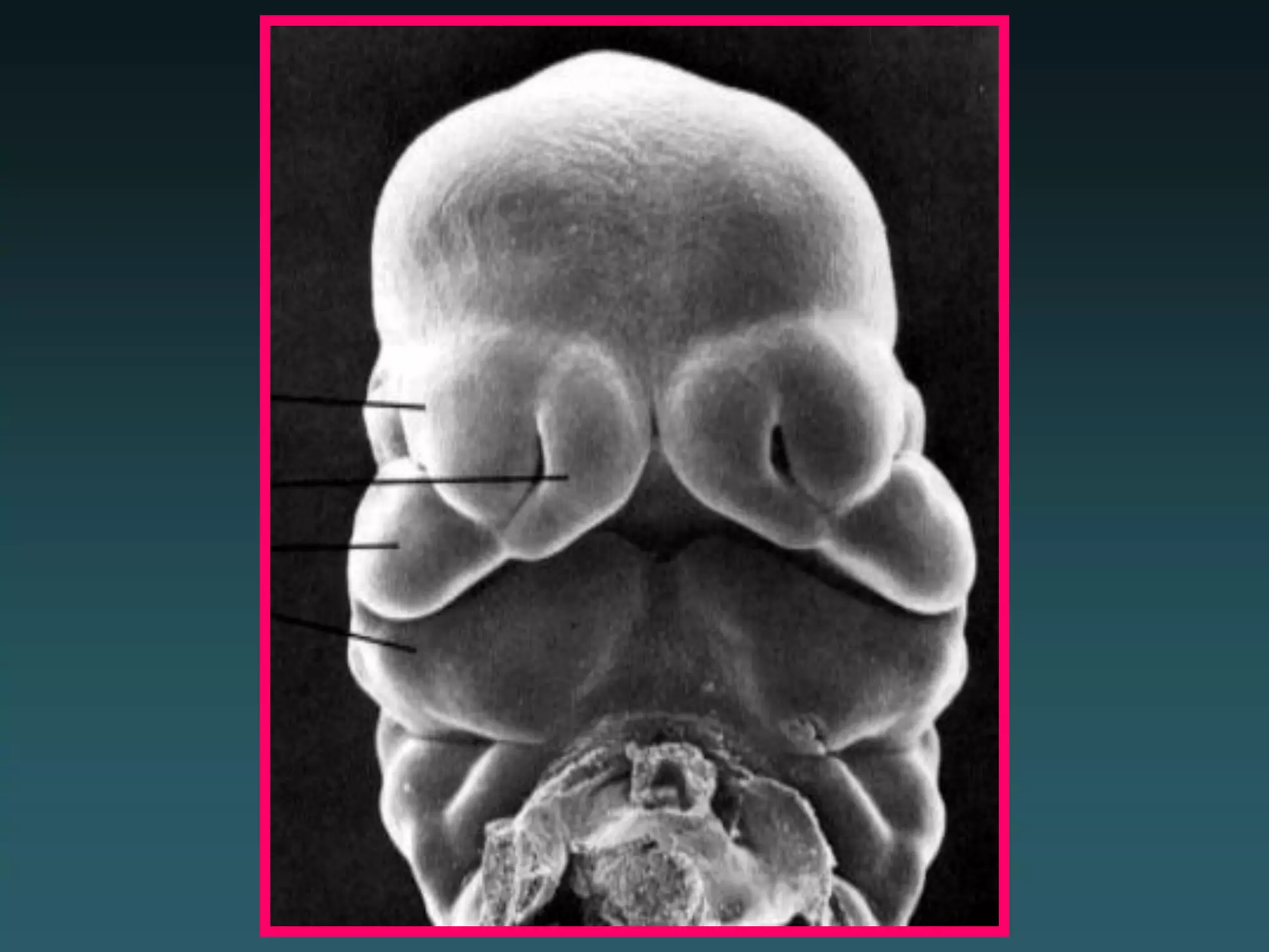Craniofacial embryology Implications for craniofacial syndromes - July ...